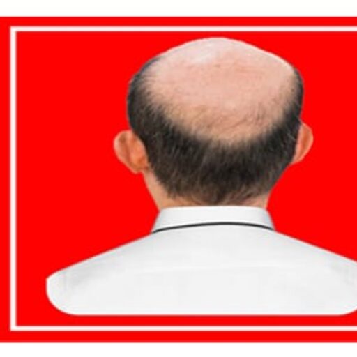 Hair Fixing Center In Hyderabad Farhan Hair Fixing